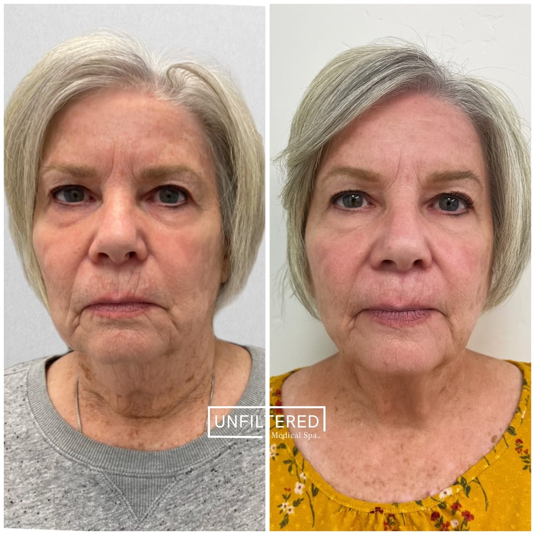 Liquid Lipo In South Jordan, UT | Unfiltered Medical Spa