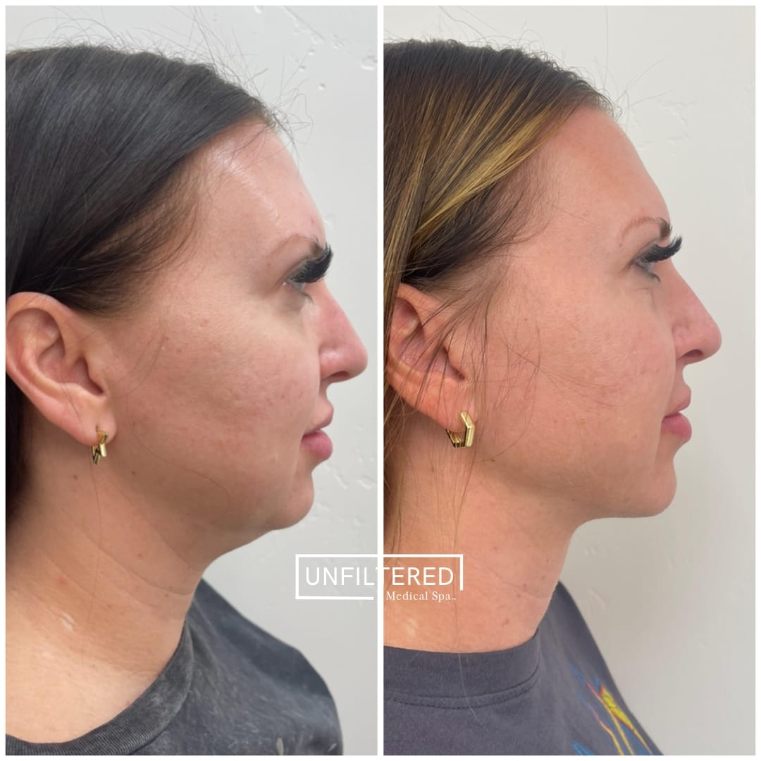 Liquid Lipo In South Jordan, UT | Unfiltered Medical Spa