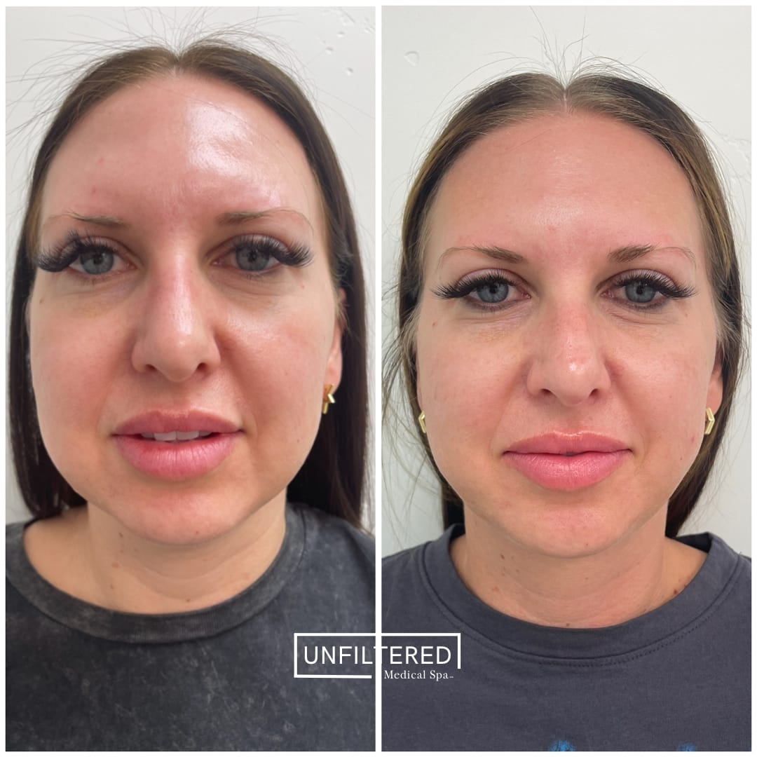 Liquid Lipo In South Jordan, UT | Unfiltered Medical Spa