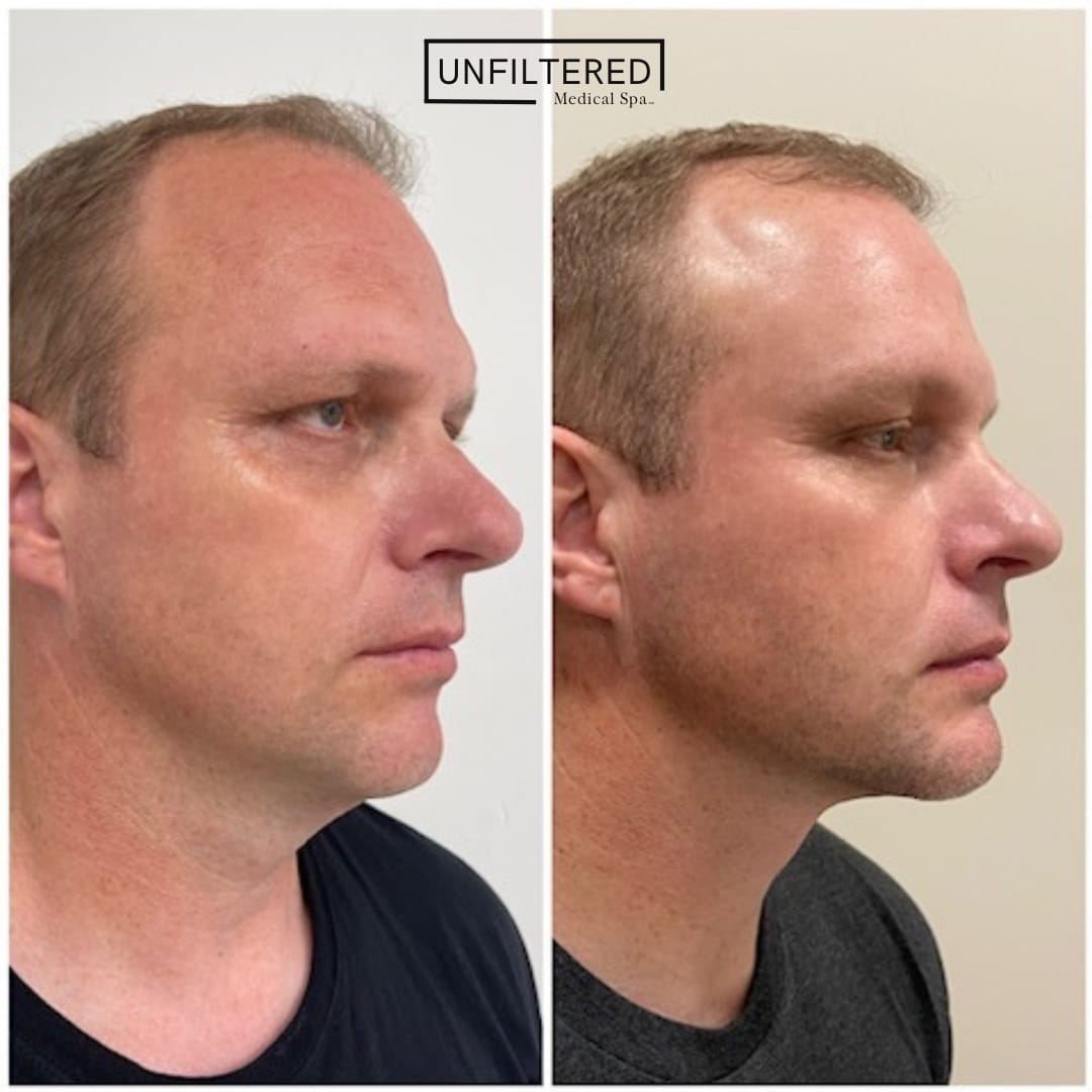 Liquid Lipo In South Jordan, UT | Unfiltered Medical Spa